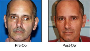 Pre and Post-Op Photos – Eye Docs For Kids