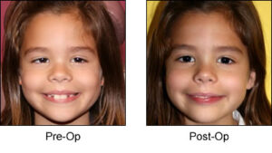 Pre and Post-Op Photos – Eye Docs For Kids