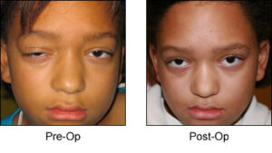 Pre and Post-Op Photos – Eye Docs For Kids