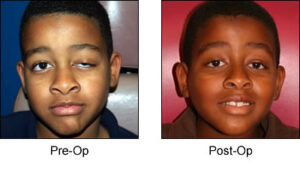 Pre and Post-Op Photos – Eye Docs For Kids