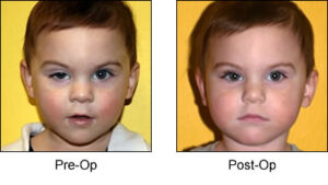 Pre and Post-Op Photos – Eye Docs For Kids